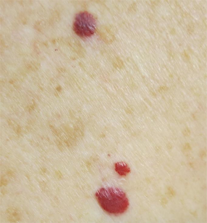 Angiome rubis - Cabinet du Dr Henry